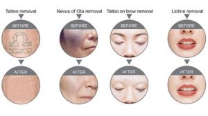 What To Expect After Q Switched Laser? - Marina Medical Center
